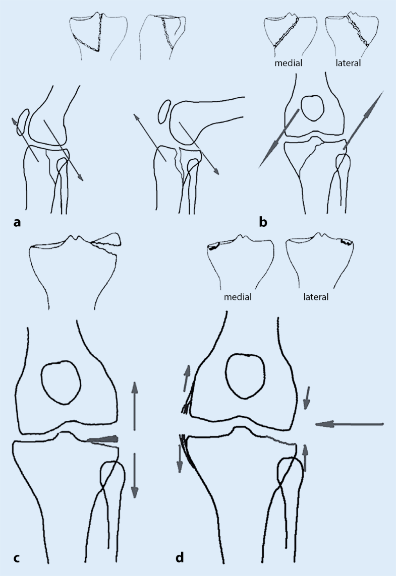 Proximale Tibiafrakturen | SpringerLink