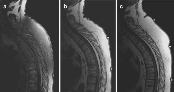 Discovertebral (Andersson) lesions in severe ankylosing spondylitis: a ...