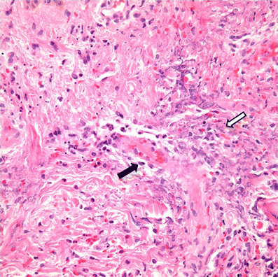A novel cutaneous vasculitis syndrome induced by levamisole ...