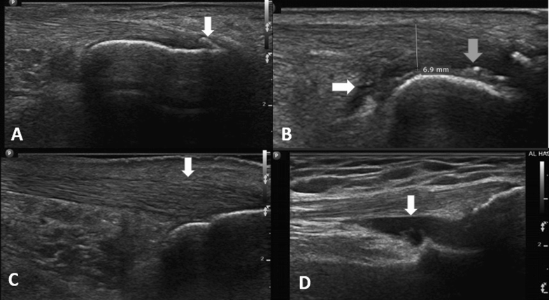 Subclinical synovitis and enthesitis in psoriasis patients and controls ...