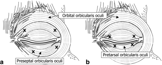A comparative crossover study on the treatment of hemifacial spasm and ...