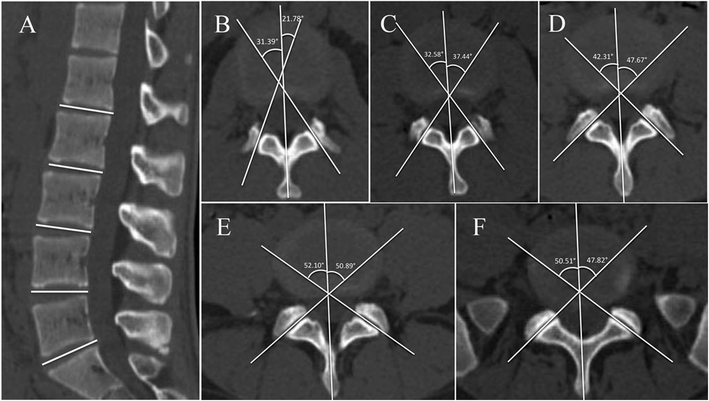 Association of facet tropism and orientation with lumbar disc ...