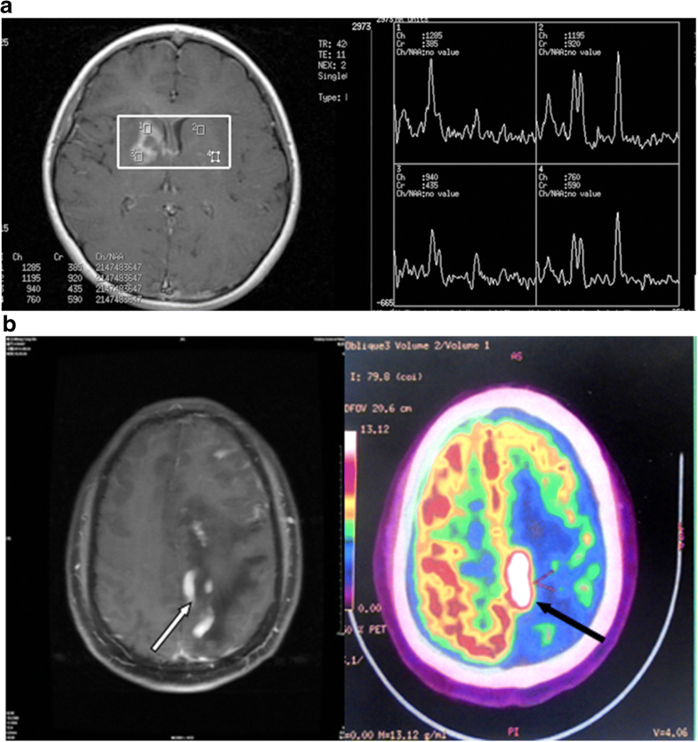 Imaging features (CT, MRI, MRS, and PET/CT) of primary central nervous ...