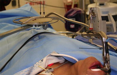 Transoral laser microsurgery for laryngeal cancer: A primer and review ...