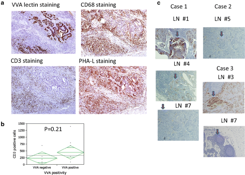 Lectin Microarray Technology Identifies Specific Lectins Related To
