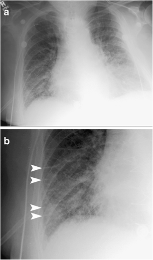 Emergency radiology eponyms: part 1—Pott’s puffy tumor to Kerley B ...