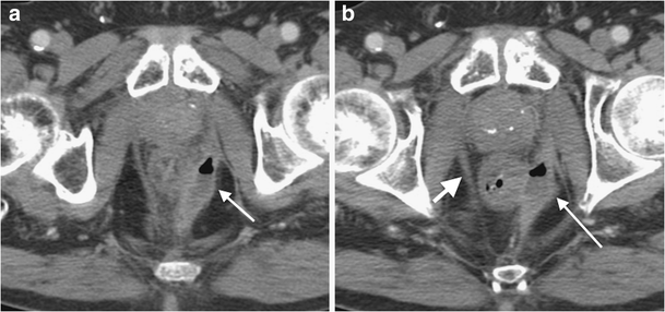 CT of acute perianal abscesses and infected fistulae: a pictorial essay ...