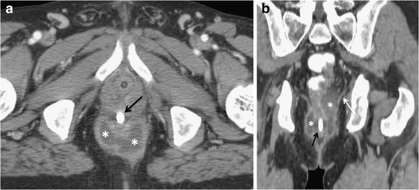 CT of acute perianal abscesses and infected fistulae: a pictorial essay ...