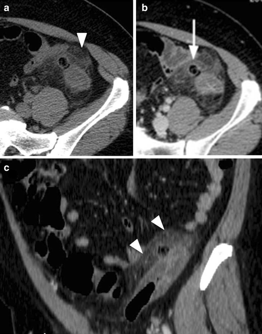 Omental infarction and its mimics: imaging features of acute abdominal ...