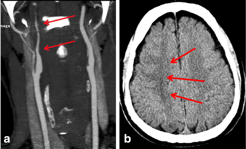 Imaging of acute ischemic stroke | SpringerLink