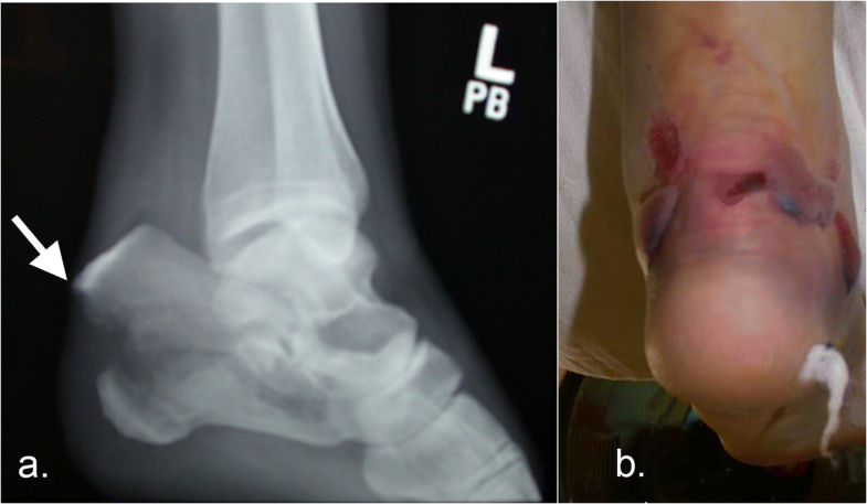 Intra-articular tongue-type fractures of the calcaneus: anatomy, injury ...