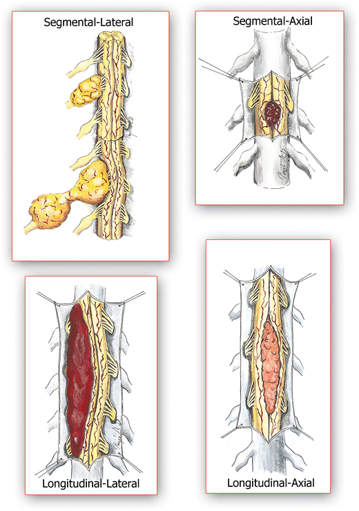 Minimally invasive spine surgery: systematic review | SpringerLink