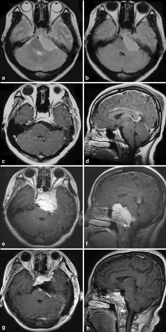 Recurrent petroclival meningiomas: clinical characteristics, management ...