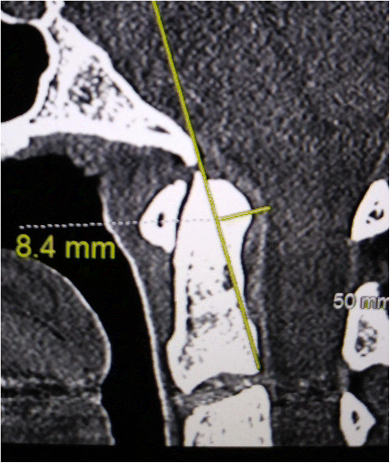 Cervical medullary syndrome secondary to craniocervical instability and ...