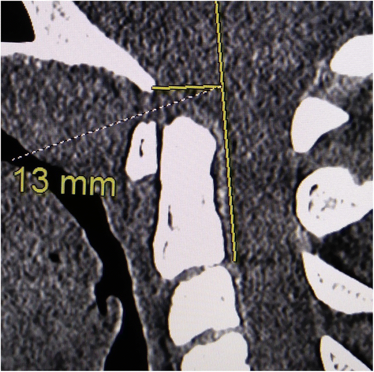 Cervical medullary syndrome secondary to craniocervical instability and ...