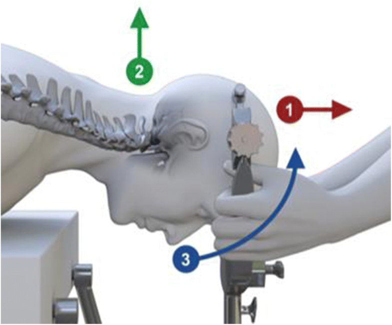 Cervical medullary syndrome secondary to craniocervical instability and ...