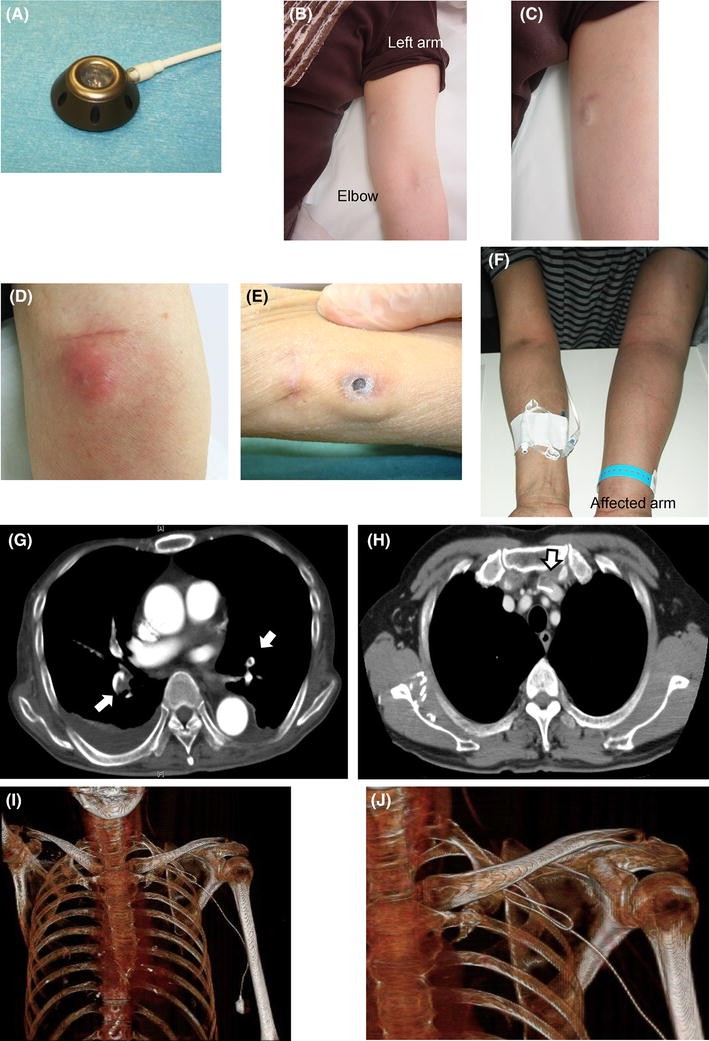 A retrospective analysis on the utility and complications of upper arm ...