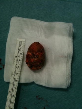 Fecaloma in an iatrogenic diverticulum: an unusual complication of the ...