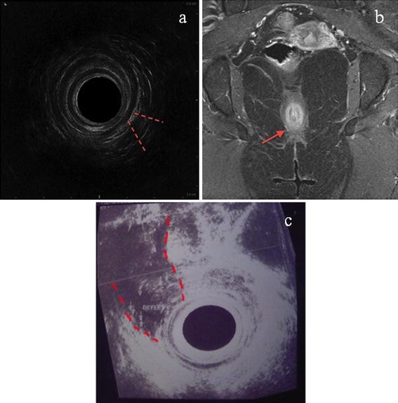 Hybrid seton for the treatment of high anal fistulas: results of 128 ...