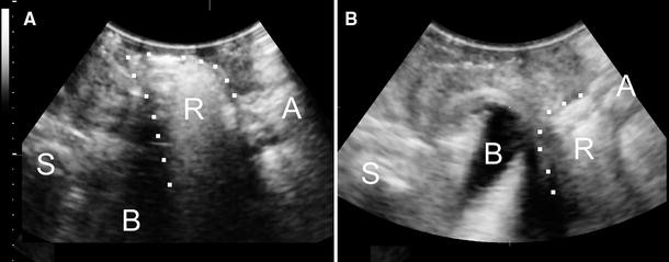 Translabial ultrasound in the assessment of pelvic floor and anorectal ...