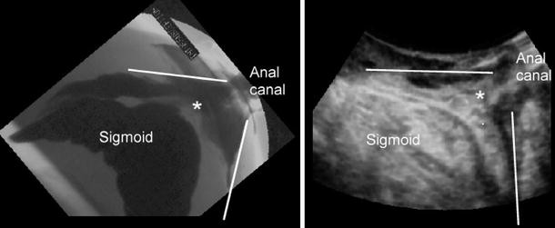 Translabial ultrasound in the assessment of pelvic floor and anorectal ...