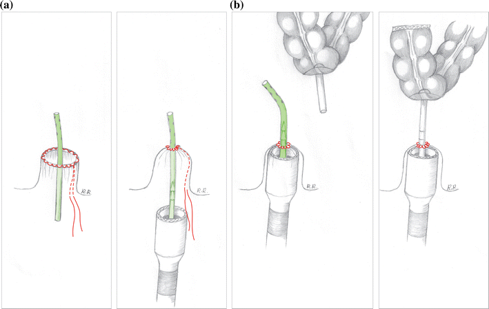 Four anastomotic techniques following transanal total mesorectal ...