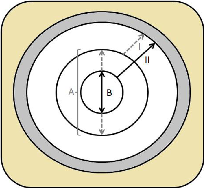 The “Cone” stoma: stoma creation in the presence of significant bowel ...