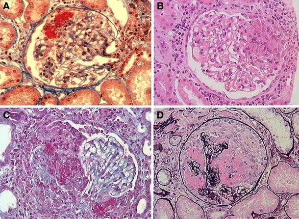 Pathology of ANCA-associated vasculitis | SpringerLink