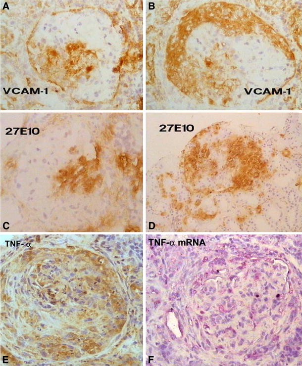 Pathology of ANCA-associated vasculitis | SpringerLink