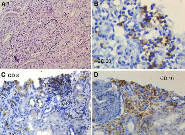 Pathology of ANCA-associated vasculitis | SpringerLink