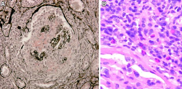Pathology of ANCA-associated vasculitis | SpringerLink