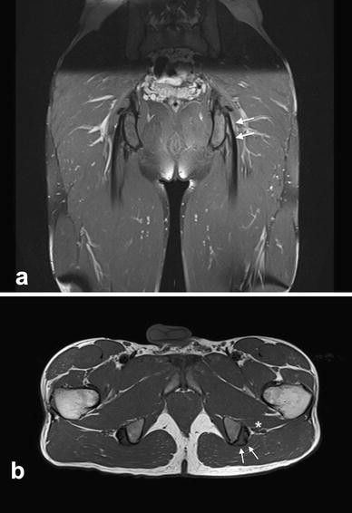Surgical management of chronic proximal hamstring tendinopathy in ...