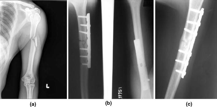 Plate osteosynthesis of fractures of the shaft of the humerus ...