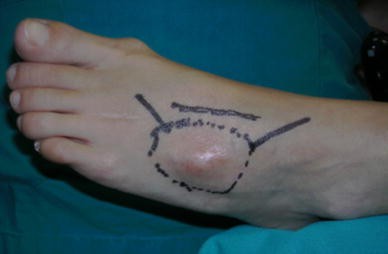 Midfoot reconstruction with serratus anterior–rib osteomuscular free ...