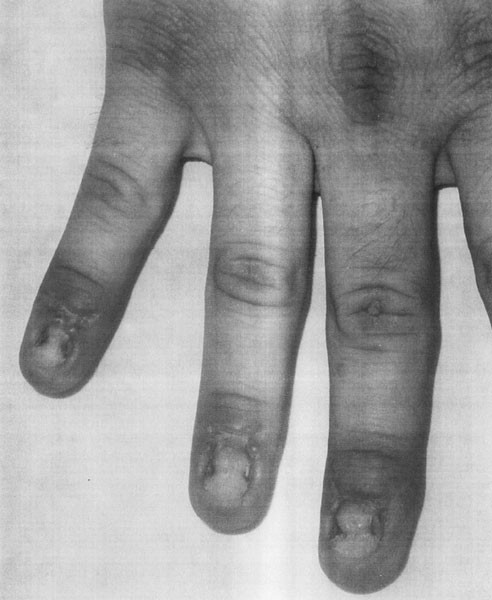 Pincer Nail Deformity Associated with Systemic Lupus Erythematosus ...