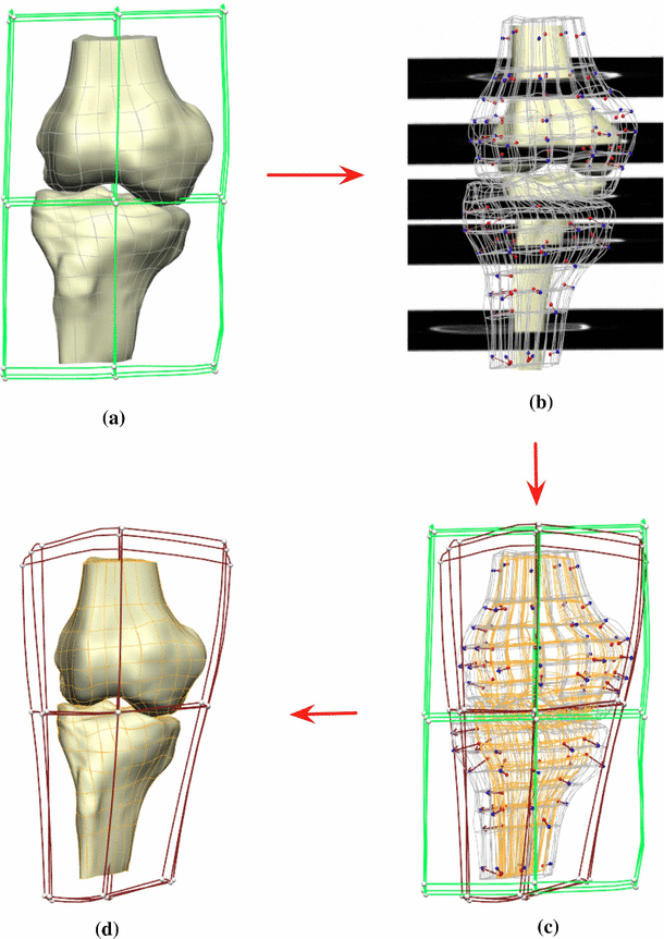 The influence and biomechanical role of cartilage split line pattern on ...