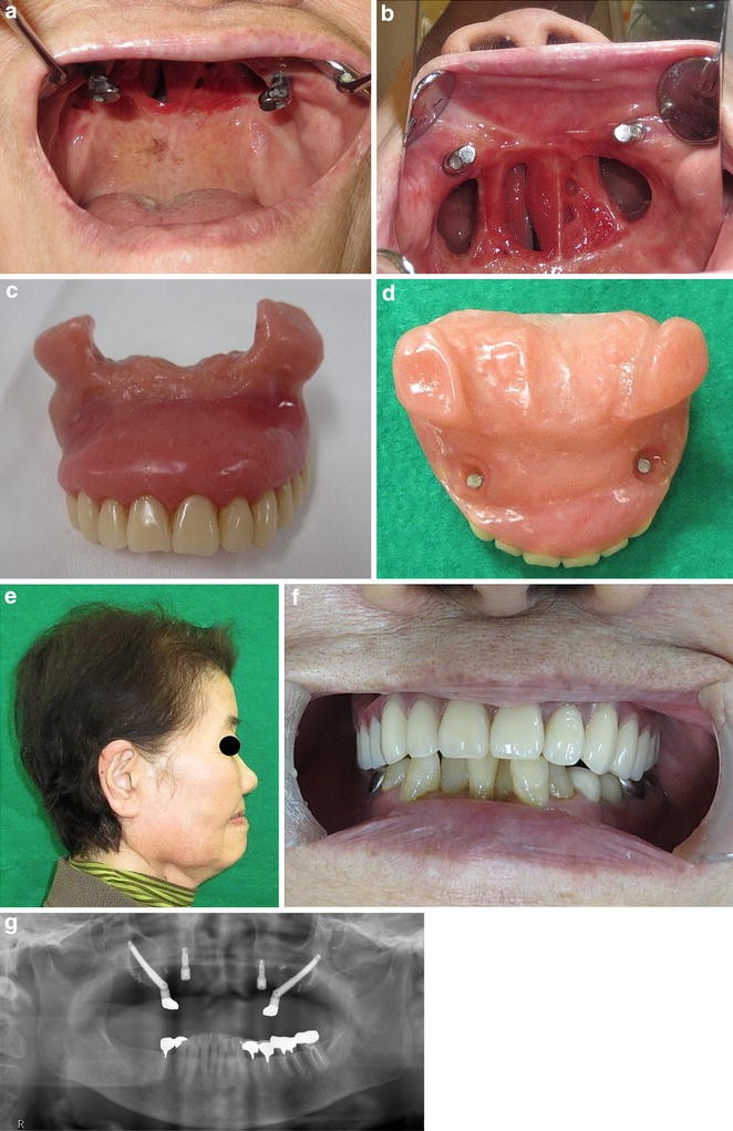 Functional and aesthetic rehabilitation with maxillary prosthesis ...