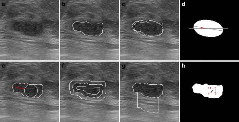 Quantitative Ultrasound Analysis for Classification of BI-RADS Category ...