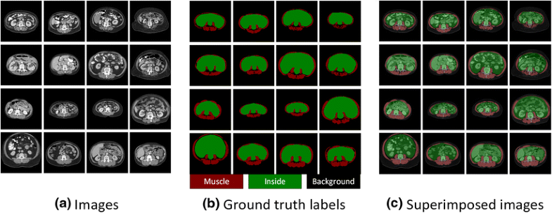 Pixel-Level Deep Segmentation: Artificial Intelligence Quantifies Muscle on Computed Tomography ...