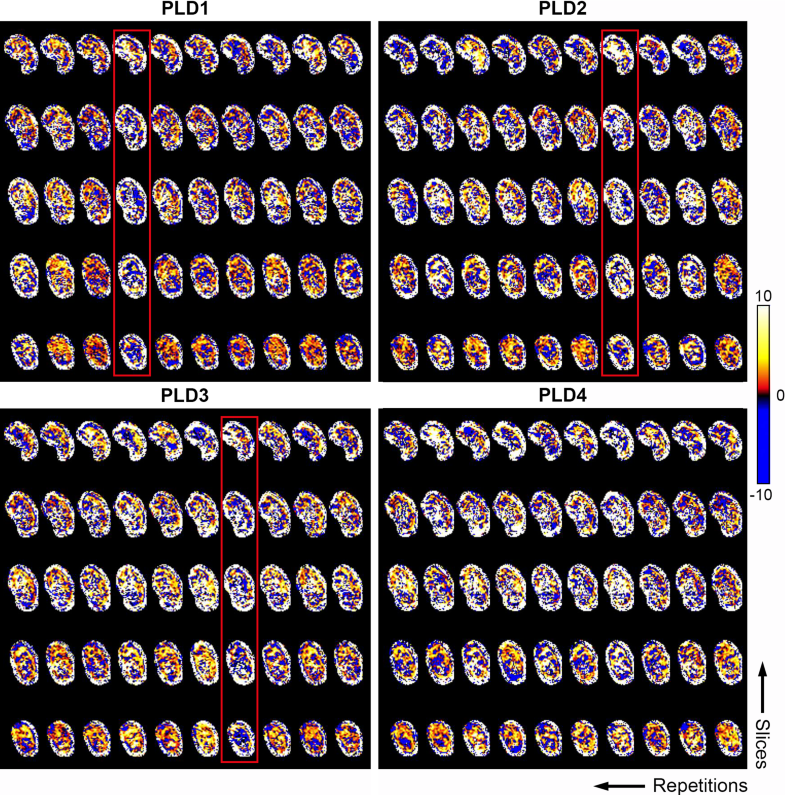 Comparison of multi-delay FAIR and pCASL labeling approaches for renal perfusion quantification ...