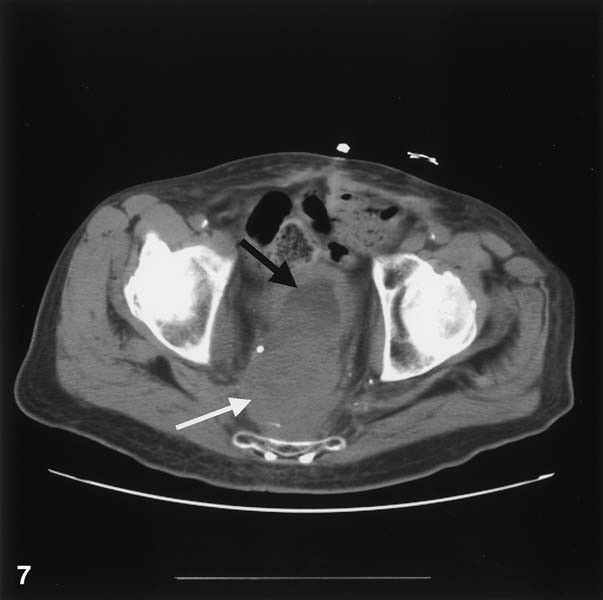 Tumors of the Retrorectal Space | SpringerLink