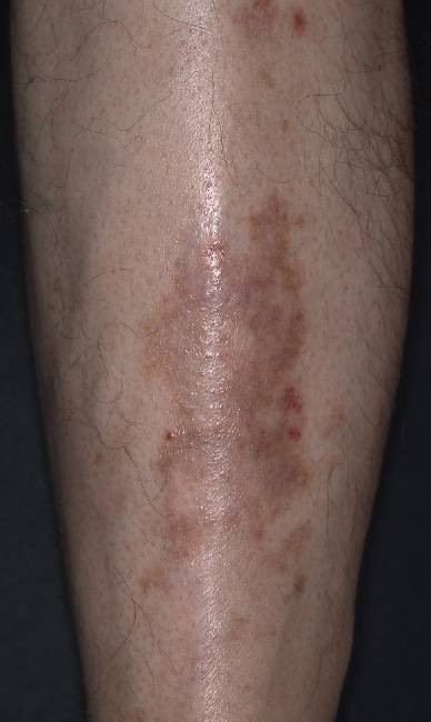 Differentialdiagnose der Hautveränderungen an den Beinen bei CVI ...