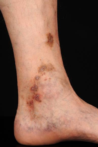 Differentialdiagnose der Hautveränderungen an den Beinen bei CVI ...