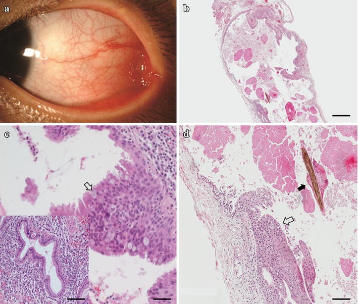 The role of entrapped cilia on the formation of lacrimal ductular cysts ...