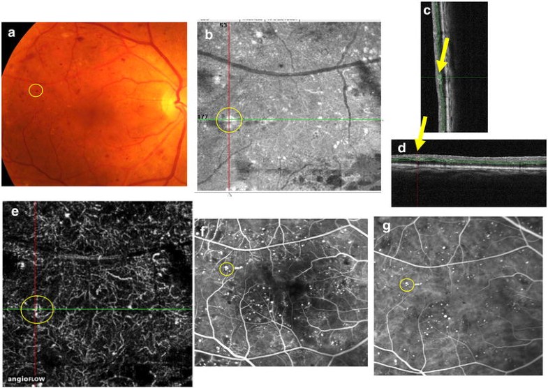 Correction to: Visualization of microaneurysms using optical coherence ...