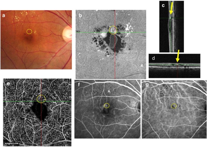 Correction to: Visualization of microaneurysms using optical coherence ...