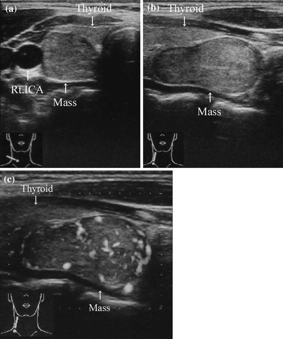 An accessory thyroid gland that presented tumor-like images | SpringerLink