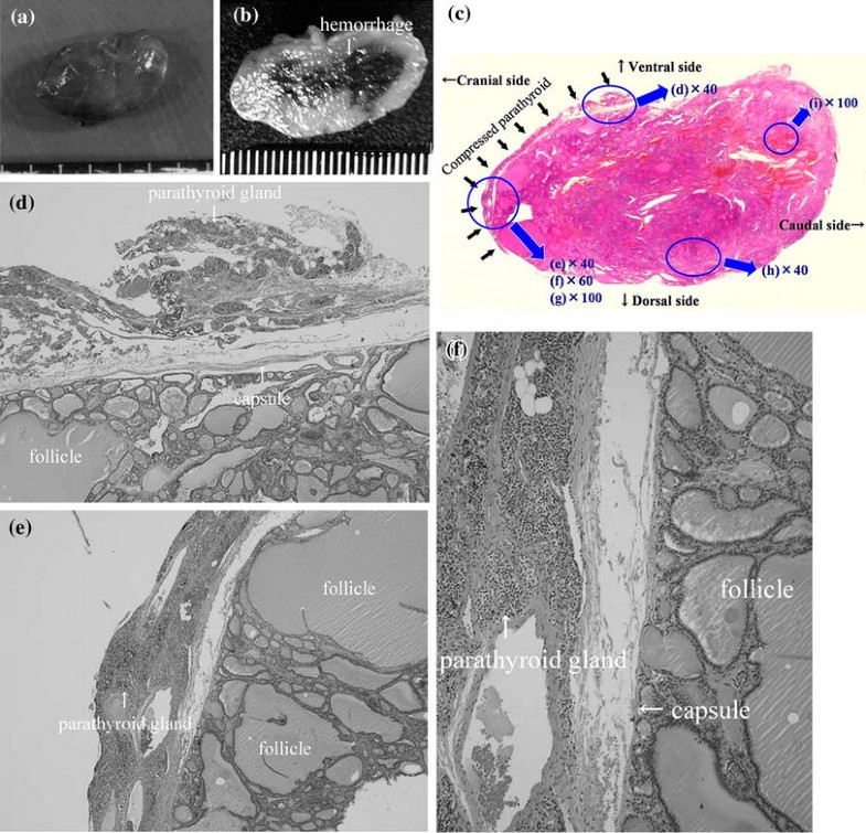 An accessory thyroid gland that presented tumor-like images | SpringerLink