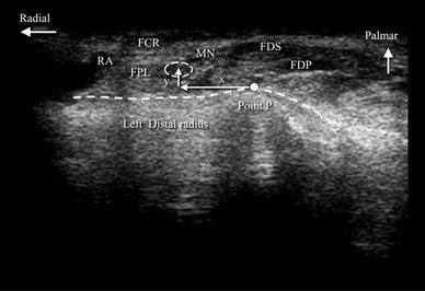 Transverse ultrasound assessment of the flexor pollicis longus tendon ...