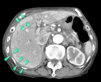Elderly Fitz-Hugh–Curtis syndrome observed with superb microvascular ...